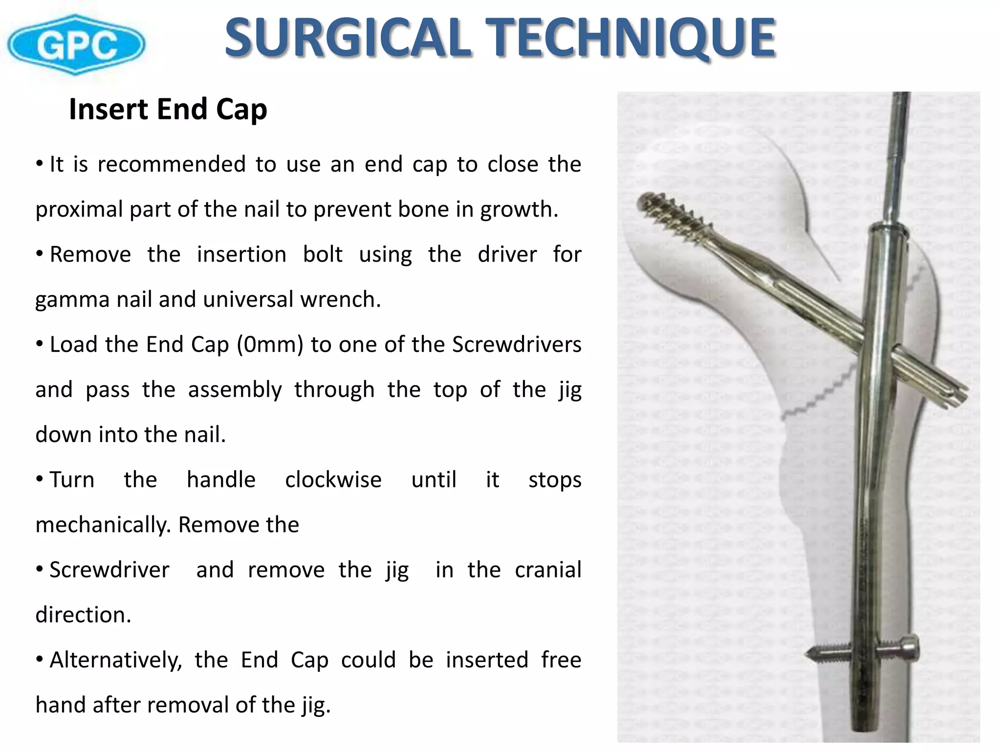 Surgical technique for gama nail | PPTX