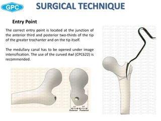 Surgical technique for gama nail | PPTX