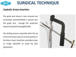 Surgical technique for gama nail | PPTX