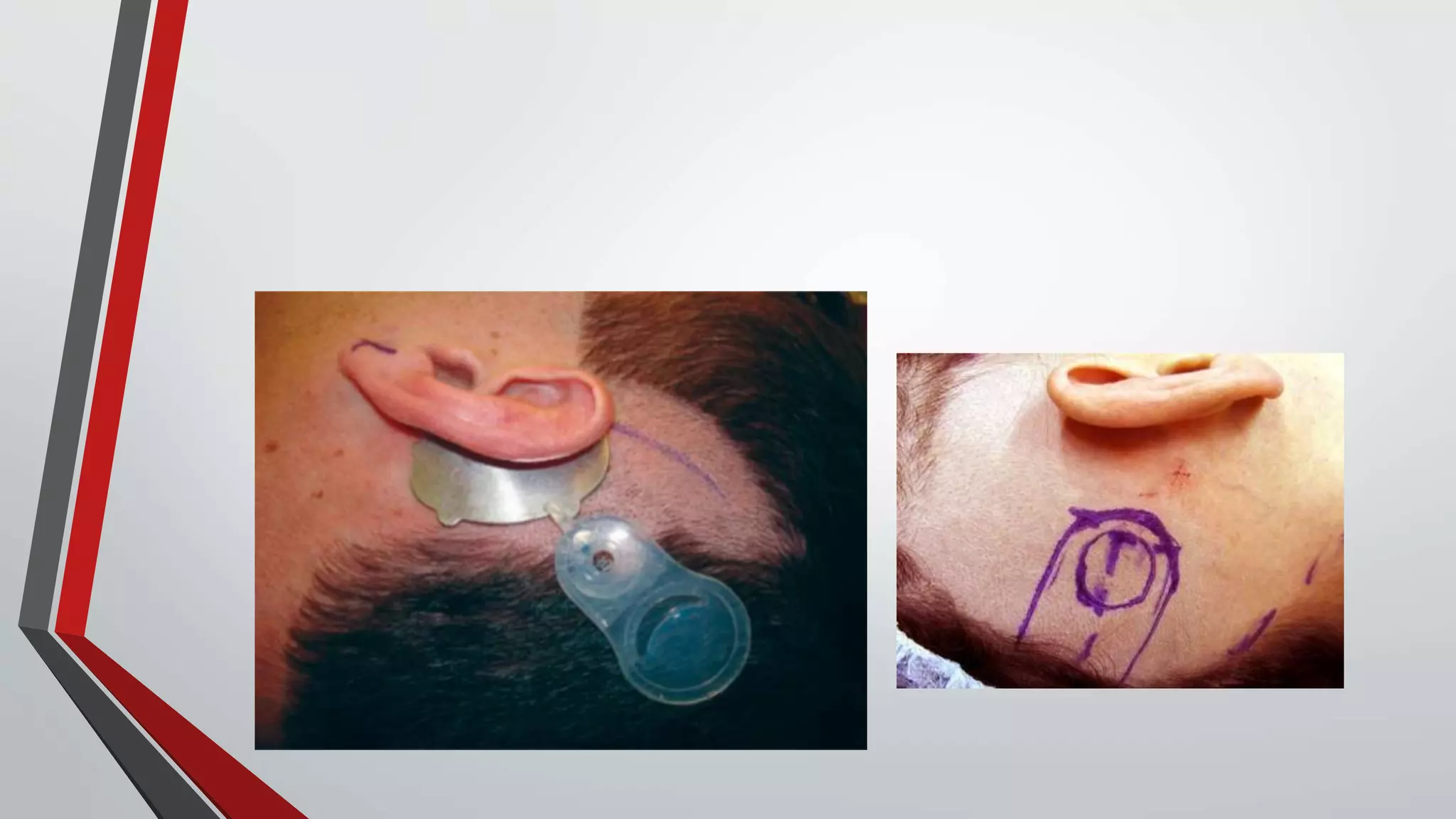 Surgical technique of cochlear implant | PPTX