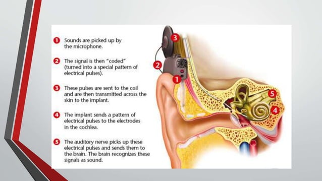 Surgical technique of cochlear implant | PPTX | Ear, Nose and Throat ...