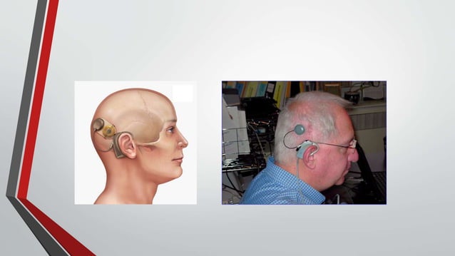 Surgical technique of cochlear implant | PPTX | Ear, Nose and Throat ...