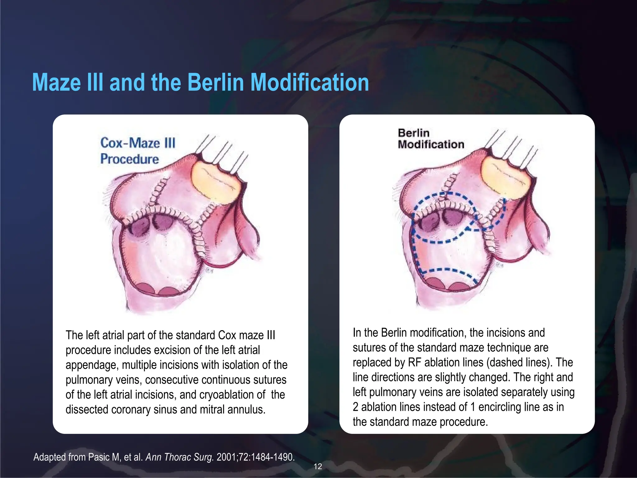 Different Surgical Techniques for Ablation.ppt