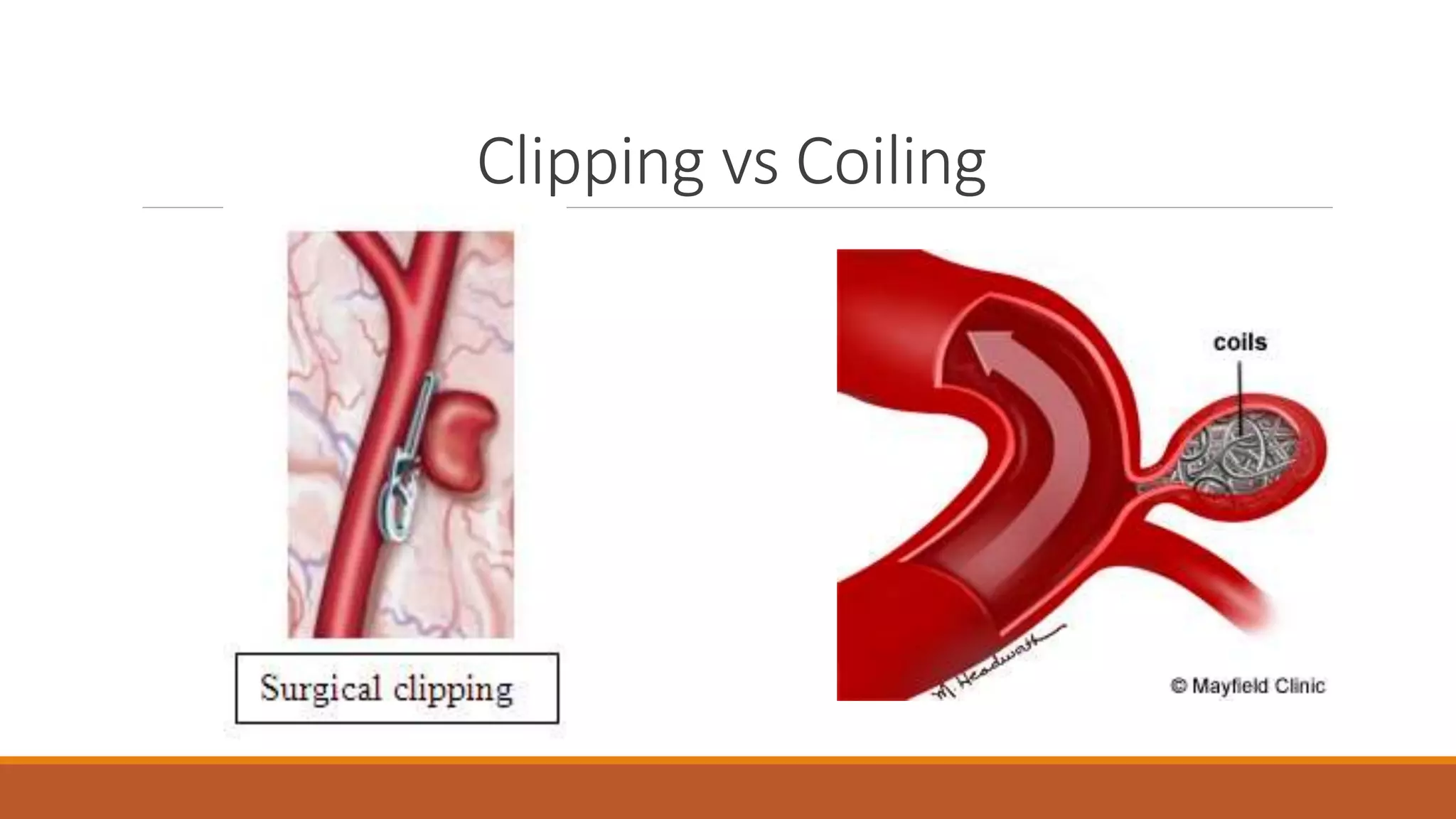 Surgical Timing & Intraventricular TPA in SAH | PPTX