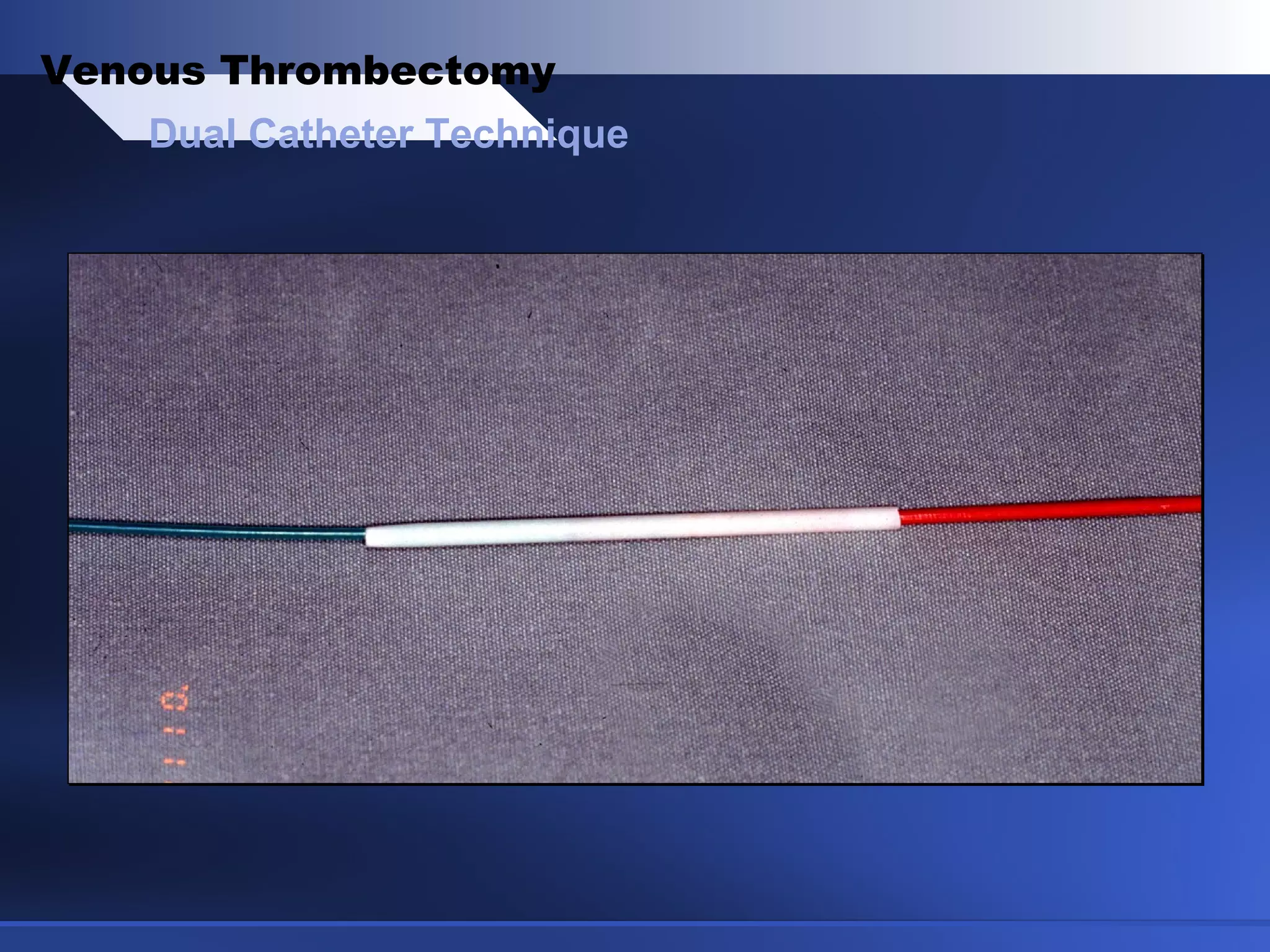 Surgical treatment acute dvt | PPT
