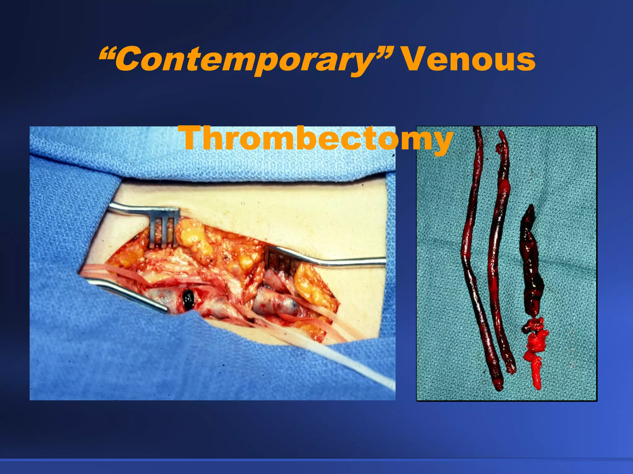 Surgical treatment acute dvt | PPT
