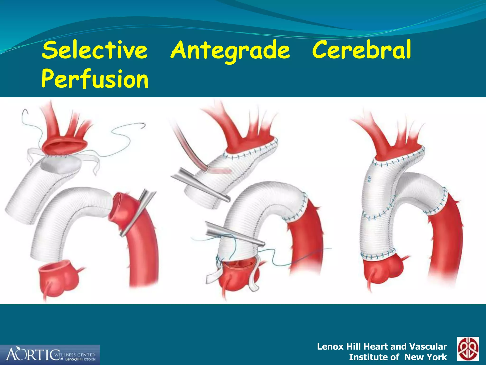 Surgical treatment for aortic arch aneurysms | PPTX