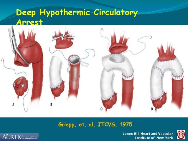 Surgical treatment for aortic arch aneurysms