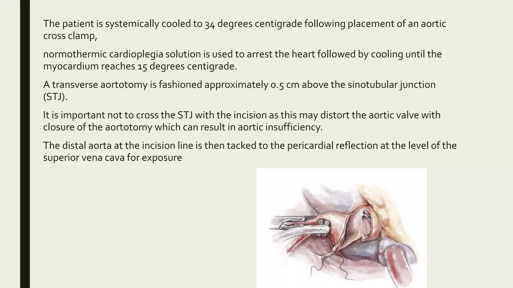 Hypertrophic Obstructive Cardiomyopathy (HOCM) | PPTX