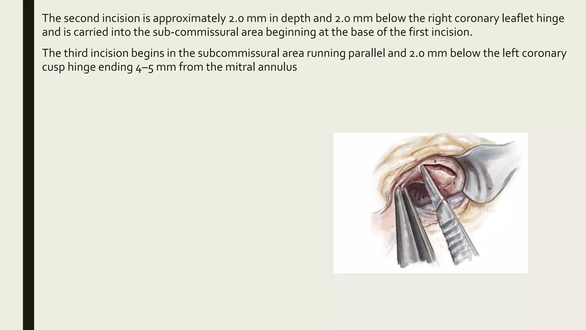 Hypertrophic Obstructive Cardiomyopathy (HOCM) | PPTX
