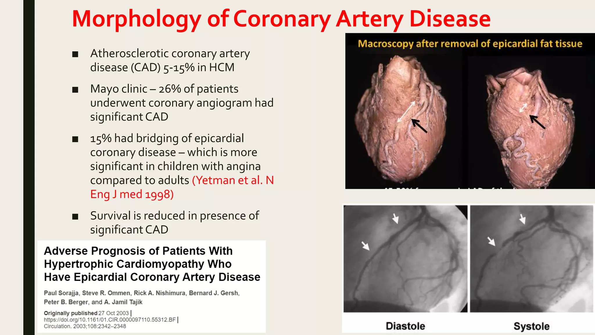 Hypertrophic Obstructive Cardiomyopathy (HOCM) | PPTX
