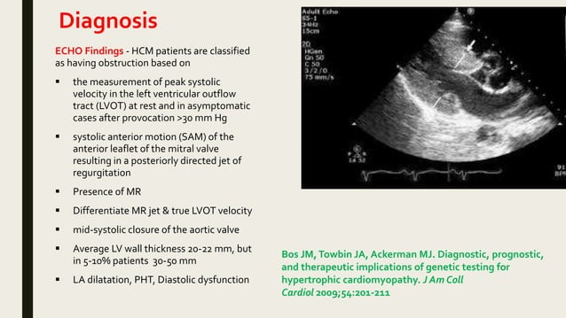 Hypertrophic Obstructive Cardiomyopathy (HOCM) | PPTX | Heart and ...