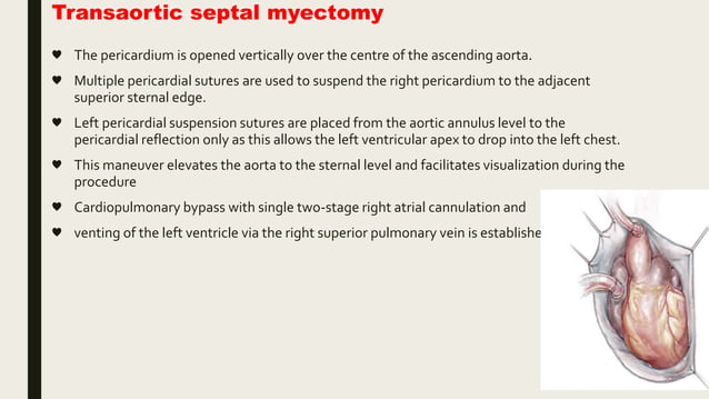 Hypertrophic Obstructive Cardiomyopathy (HOCM) | PPTX | Heart and ...