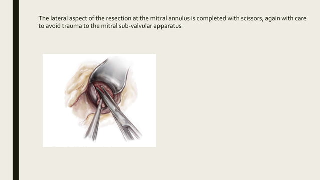 Hypertrophic Obstructive Cardiomyopathy (HOCM) | PPTX | Heart and ...