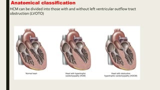 Hypertrophic Obstructive Cardiomyopathy (HOCM) | PPTX