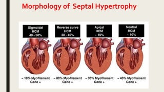 Hypertrophic Obstructive Cardiomyopathy (HOCM) | PPTX