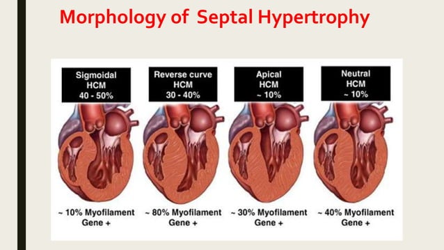 Hypertrophic Obstructive Cardiomyopathy (HOCM)