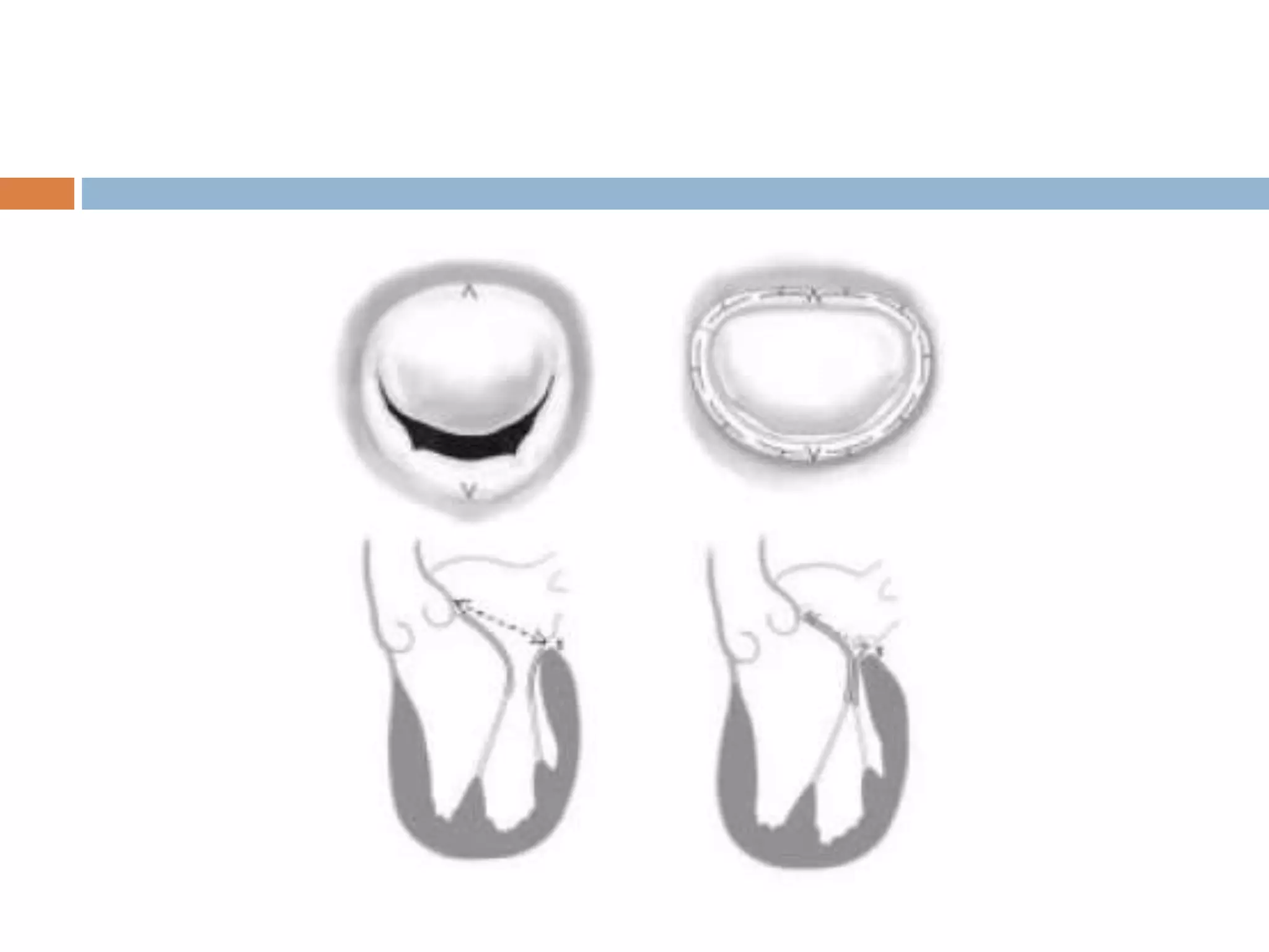 Surgical treatment for mitral valve disorders cv nurses | PPT