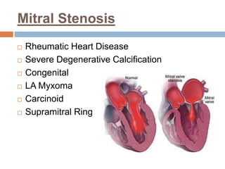 Surgical treatment for mitral valve disorders cv nurses | PPTX
