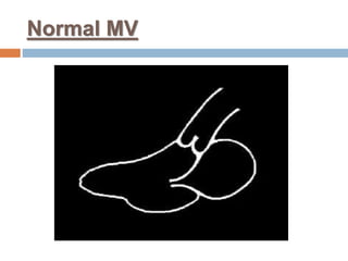 Surgical treatment for mitral valve disorders cv nurses | PPT