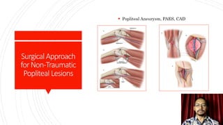 Surgical treatment for popliteal lesions | PPTX