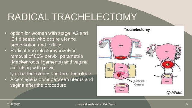 Surgical Treatment of CA Cervix 134.pptx | Reproductive Health ...