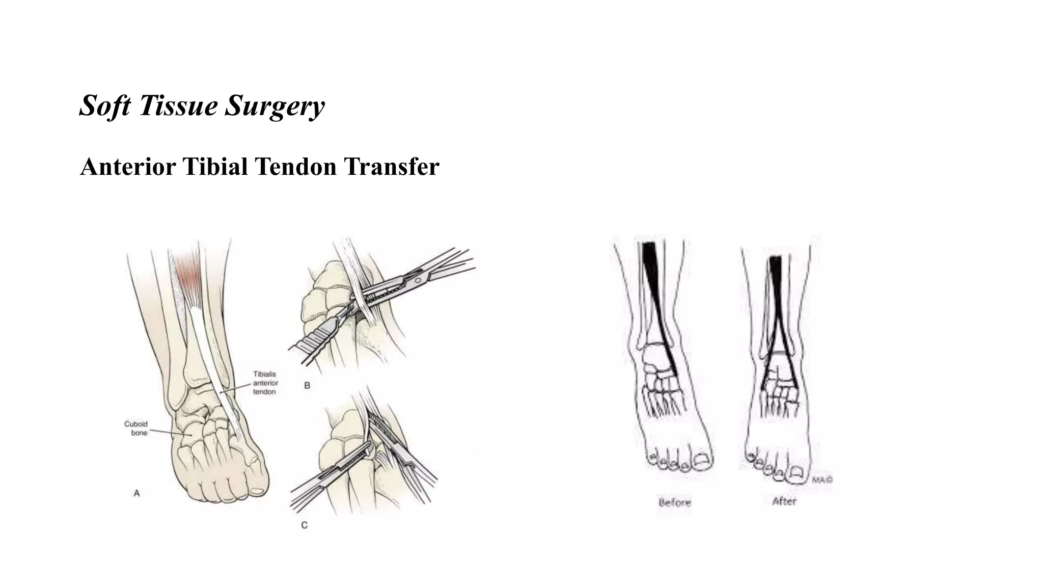 Surgical treatment of CTEV | PPTX