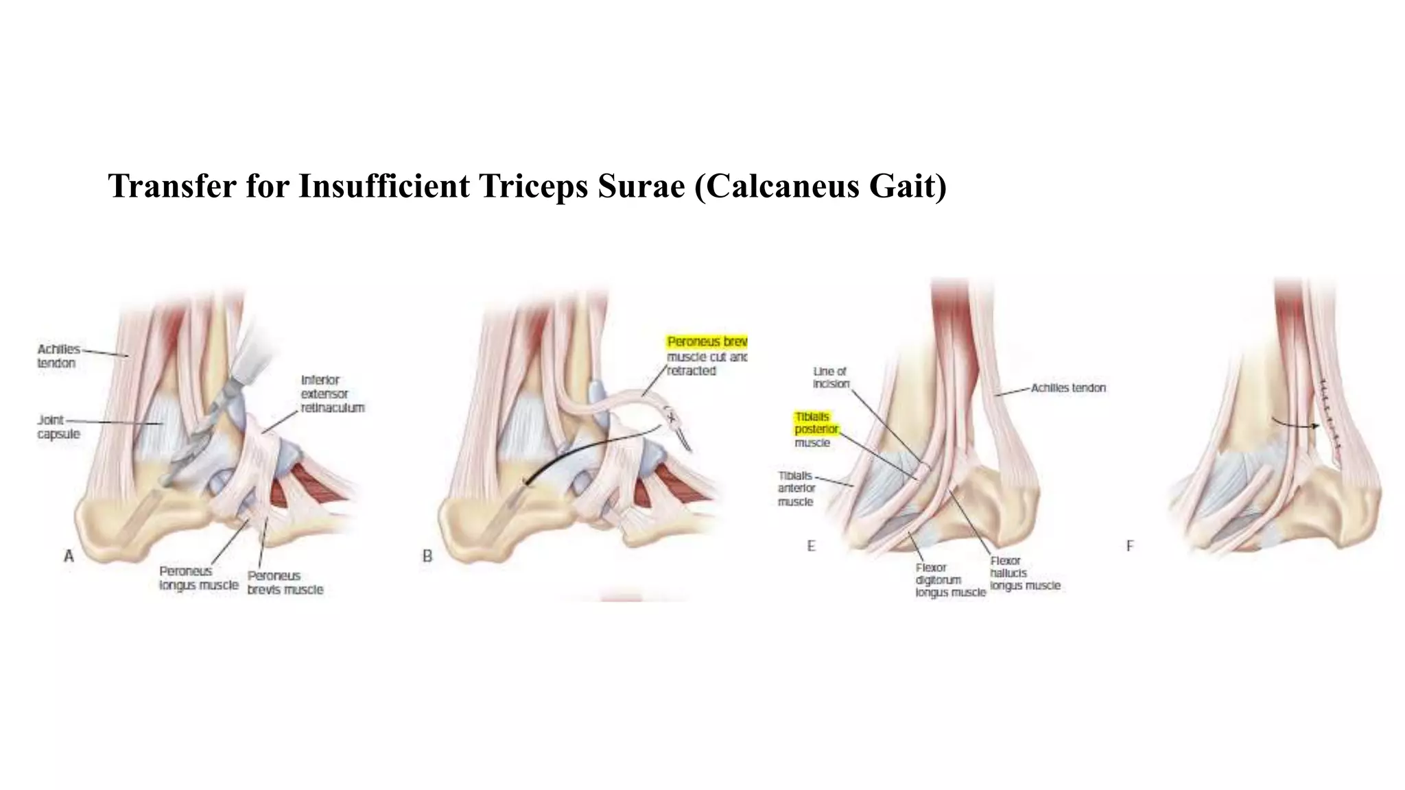 Surgical treatment of CTEV | PPTX