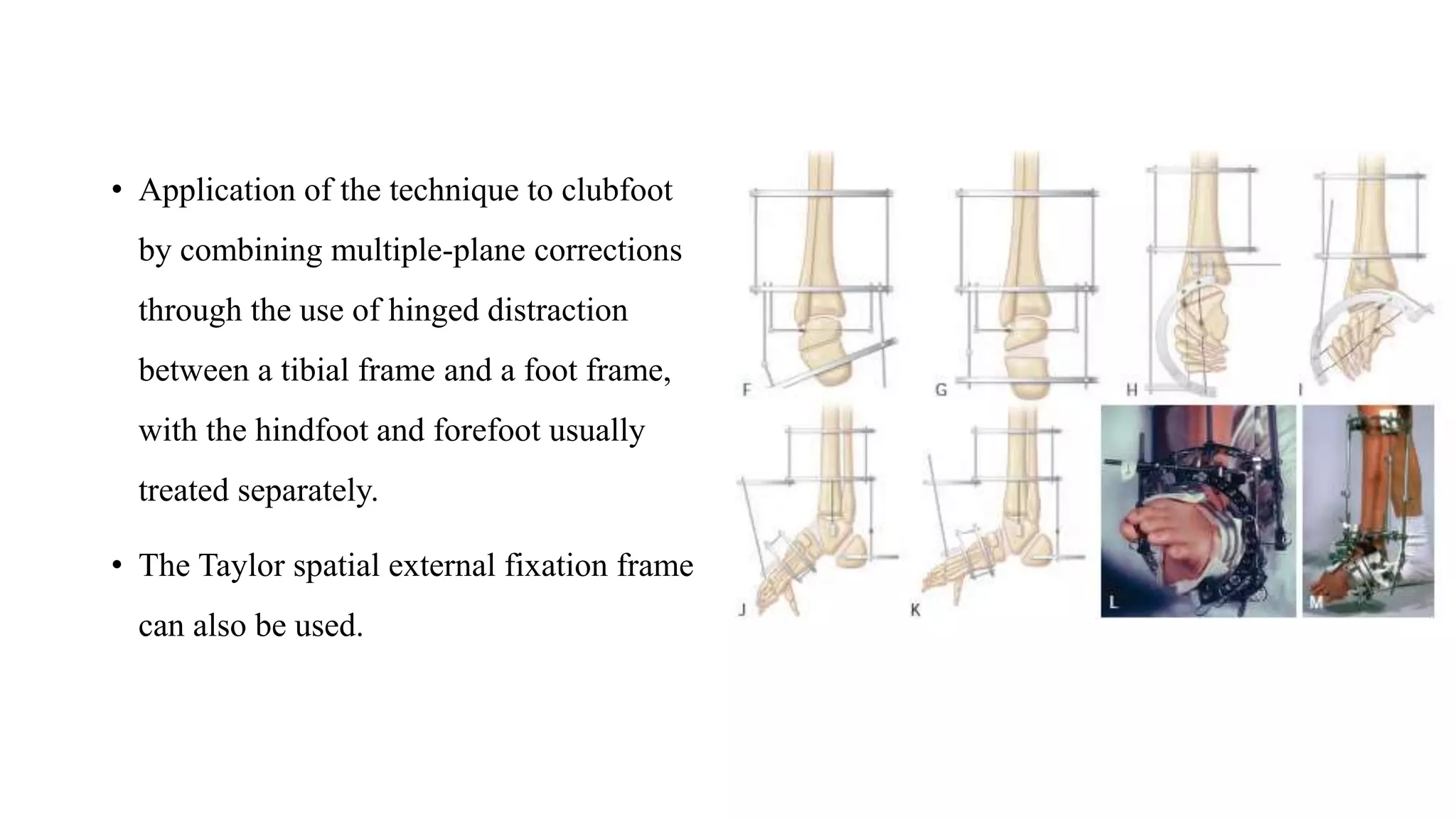 Surgical treatment of CTEV | PPTX