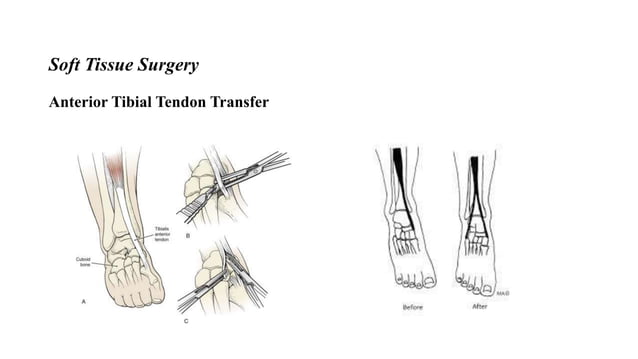 Surgical treatment of CTEV | PPTX