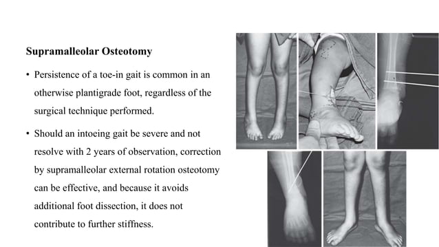 Surgical treatment of CTEV | PPTX
