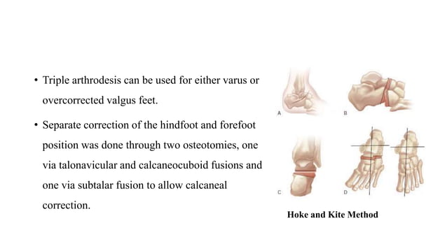 Surgical treatment of CTEV | PPTX