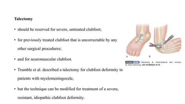 Surgical treatment of CTEV | PPTX