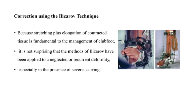 Surgical treatment of CTEV | PPTX