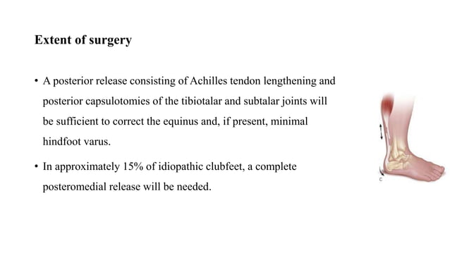 Surgical treatment of CTEV | PPTX