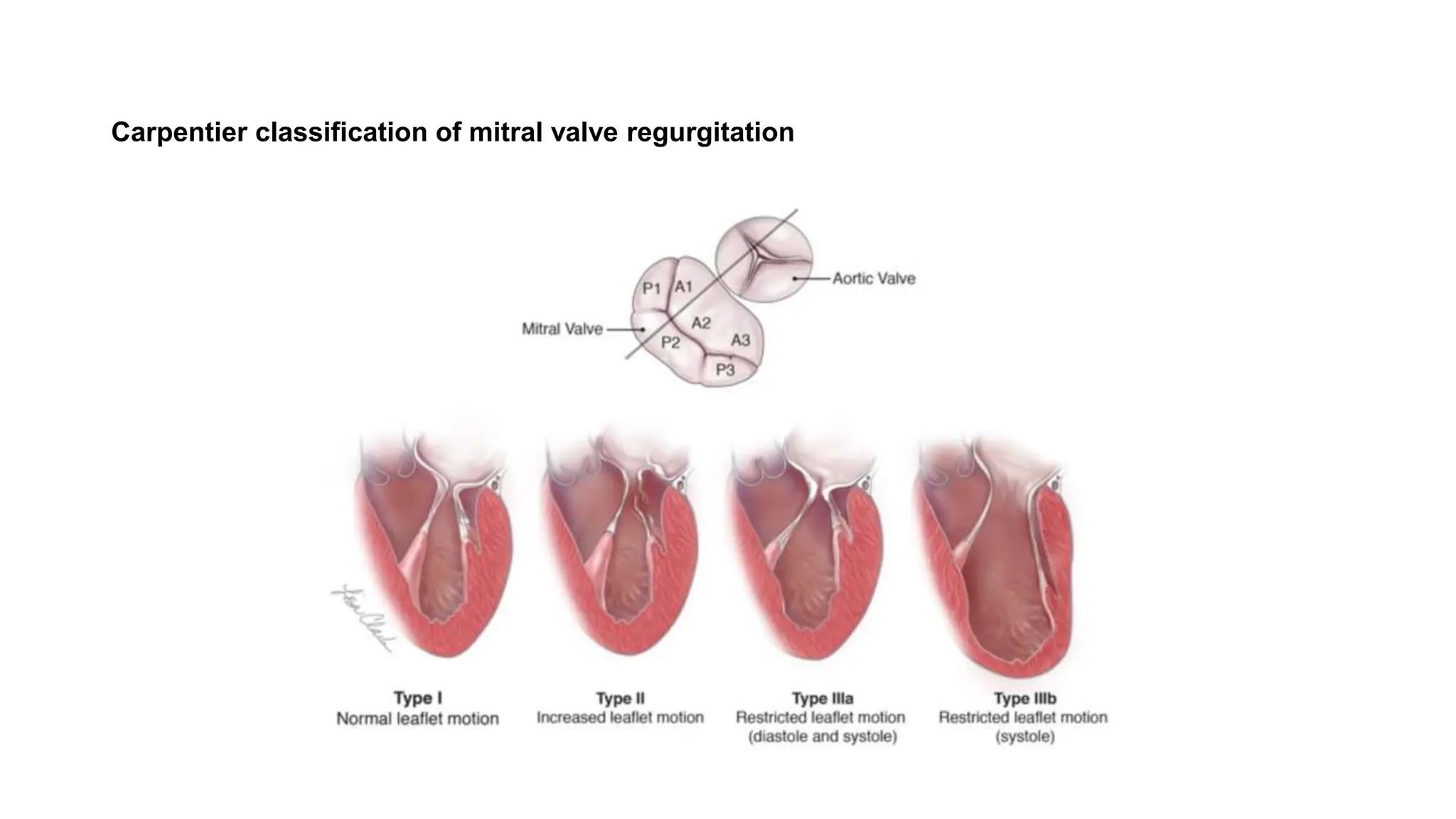 Surgical Treatment of Ischemic Mitral Regurgitation | PPT