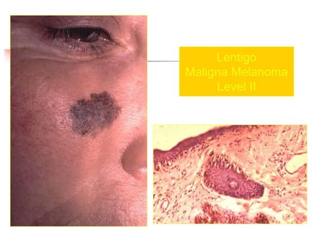 Surgical Treatment of Malignant Melanoma-1.ppt | Skin and Dermatology ...