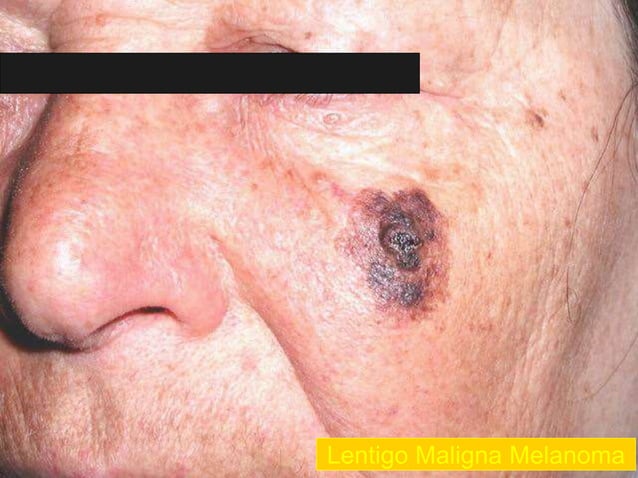 Surgical Treatment of Malignant Melanoma-1.ppt | Skin and Dermatology ...