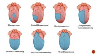 Surgical Treatment of oral cavity proper.pptx
