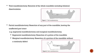 Surgical Treatment of oral cavity proper.pptx