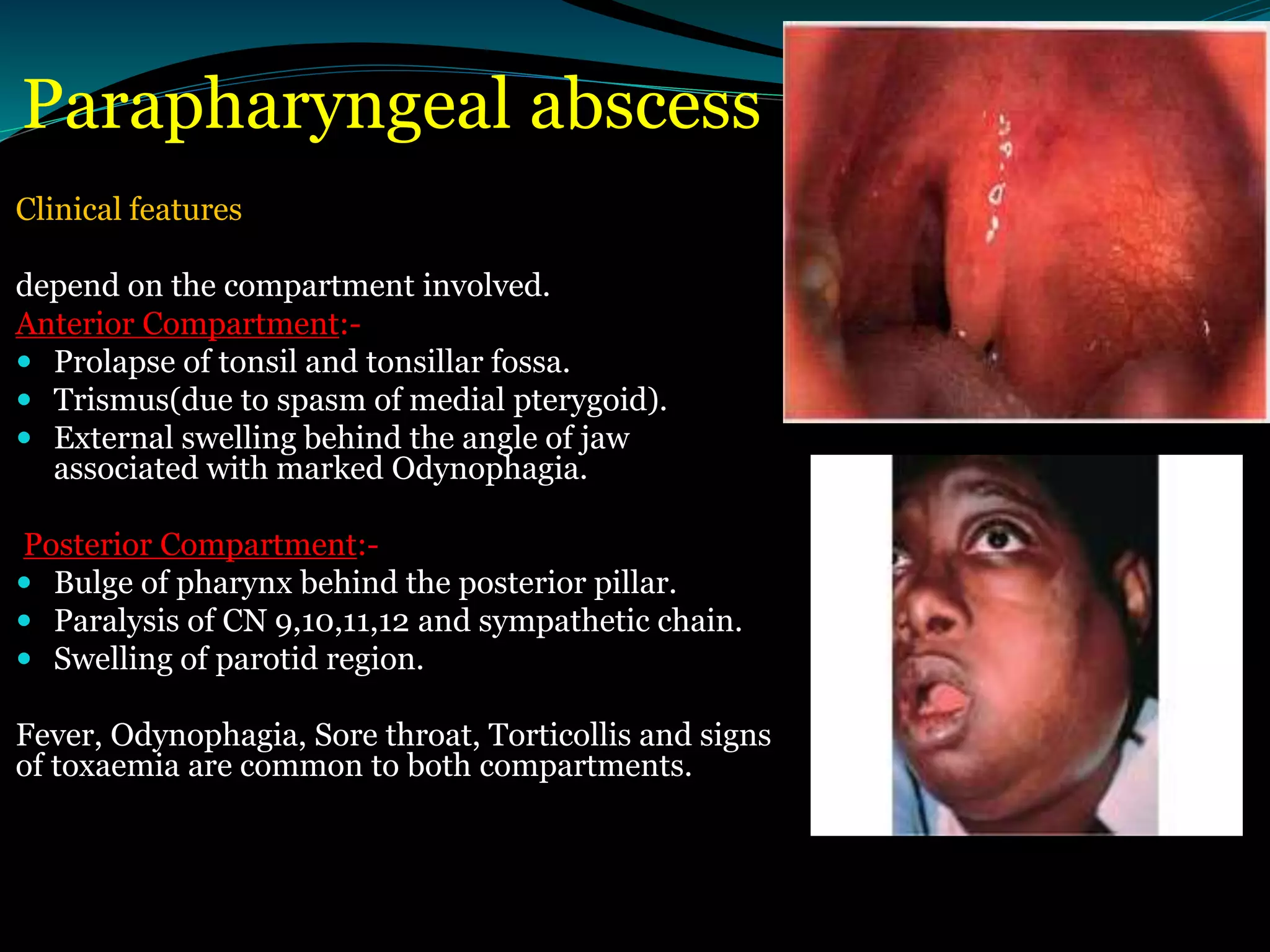 Surgical treatment of paraphyrngeal and retropharyngeal abscesses | PPTX