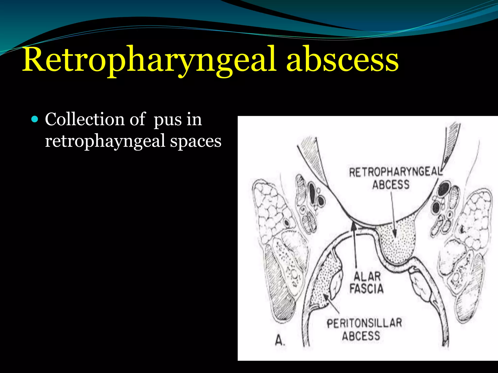 Surgical treatment of paraphyrngeal and retropharyngeal abscesses | PPTX