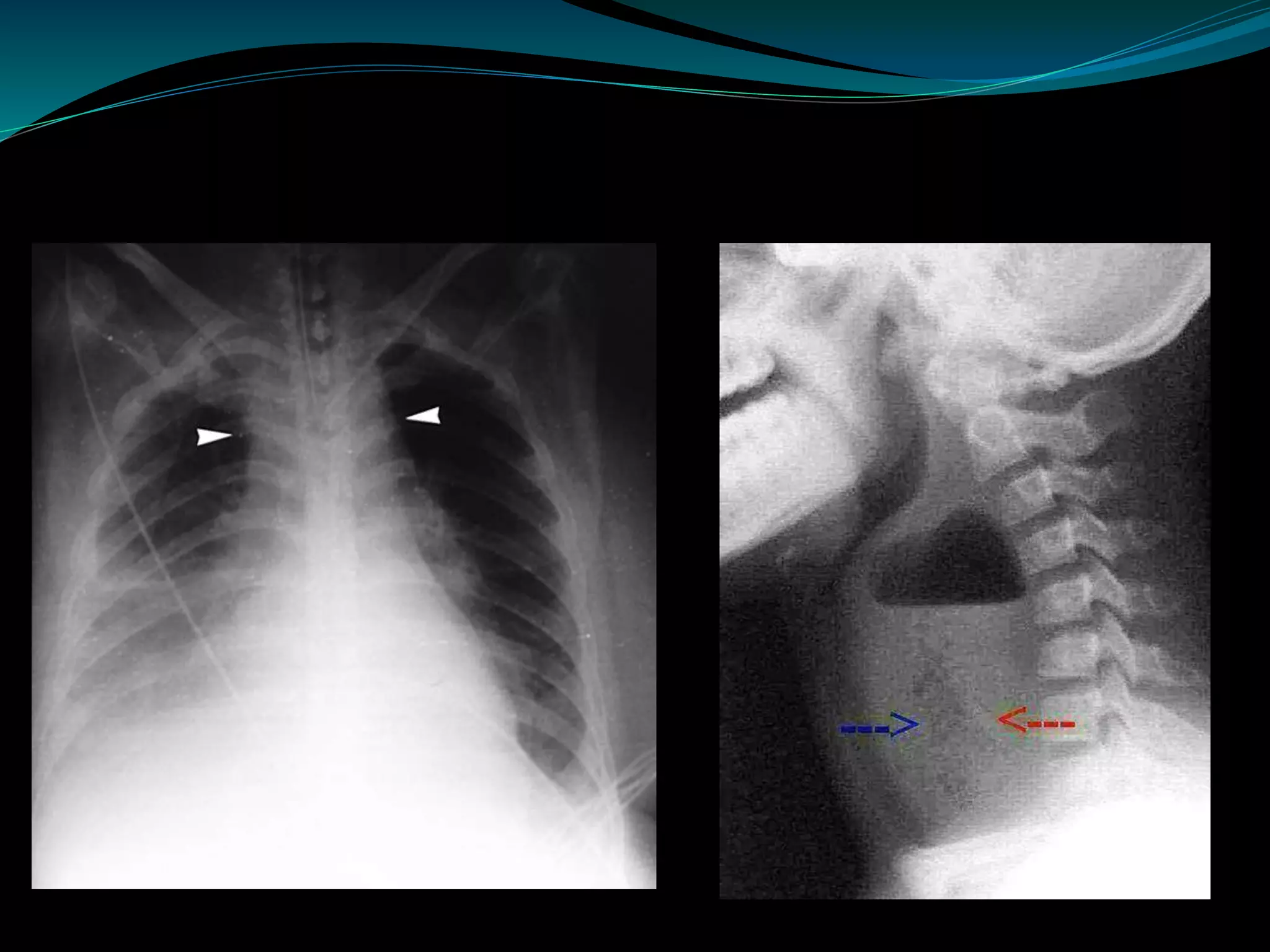 Surgical treatment of paraphyrngeal and retropharyngeal abscesses | PPTX
