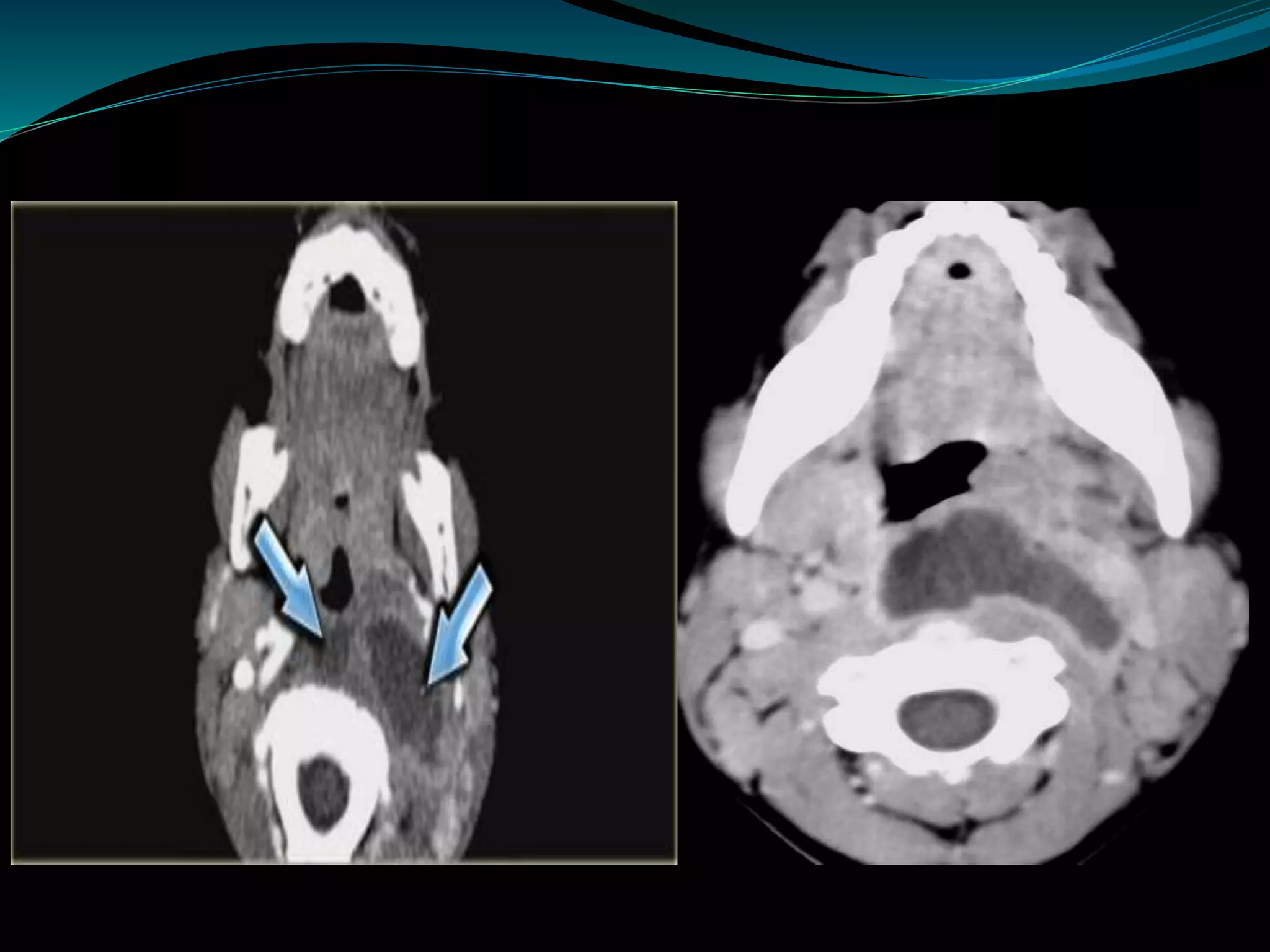 Surgical treatment of paraphyrngeal and retropharyngeal abscesses | PPTX