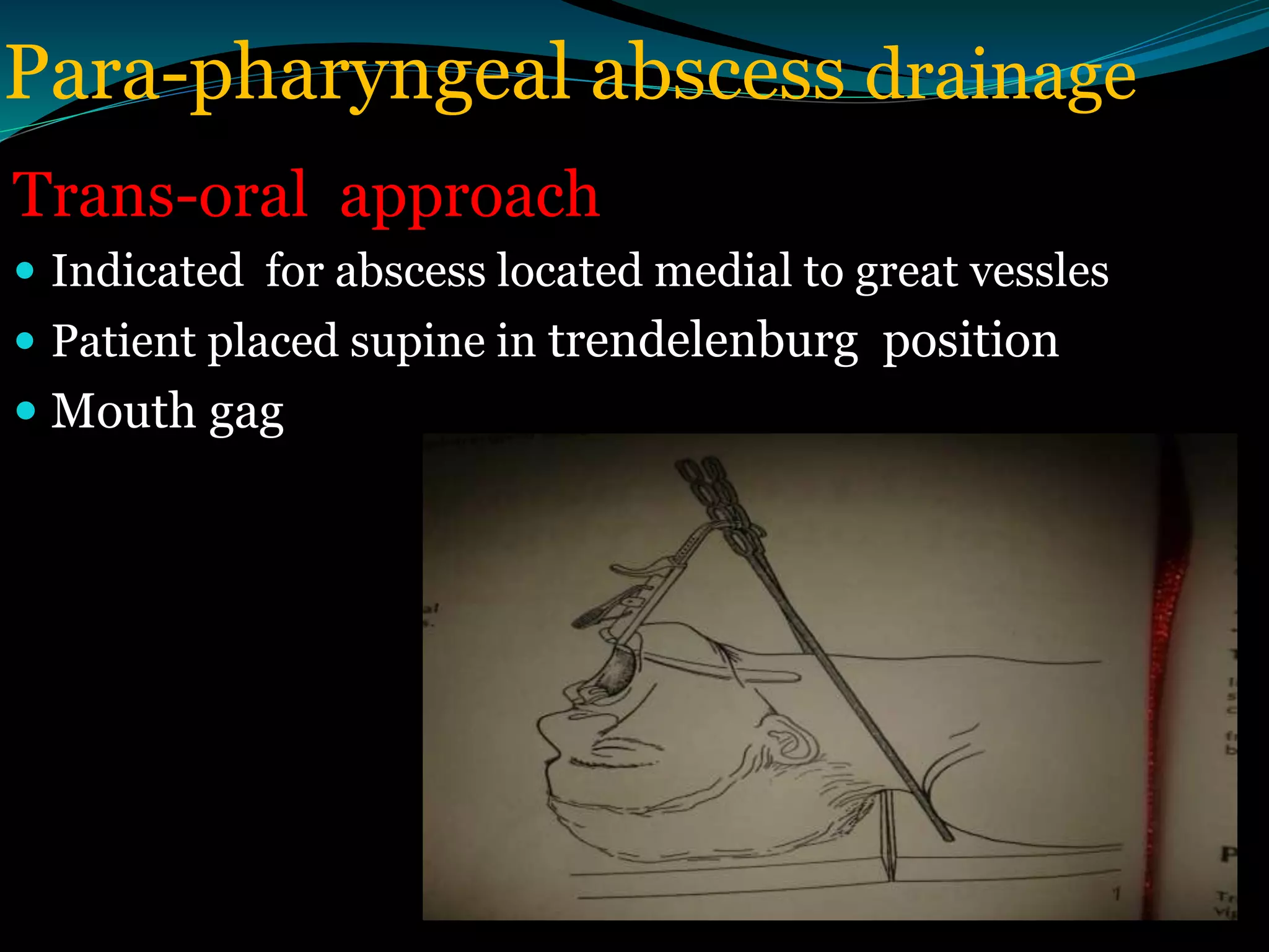 Surgical treatment of paraphyrngeal and retropharyngeal abscesses | PPTX