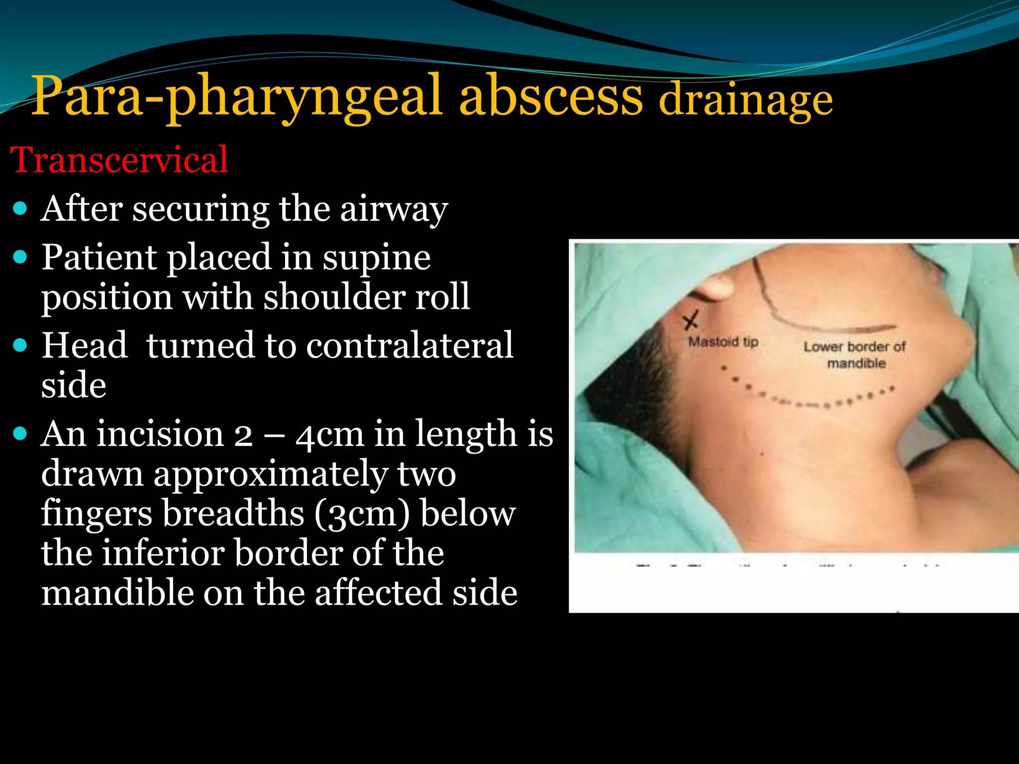Surgical treatment of paraphyrngeal and retropharyngeal abscesses | PPTX