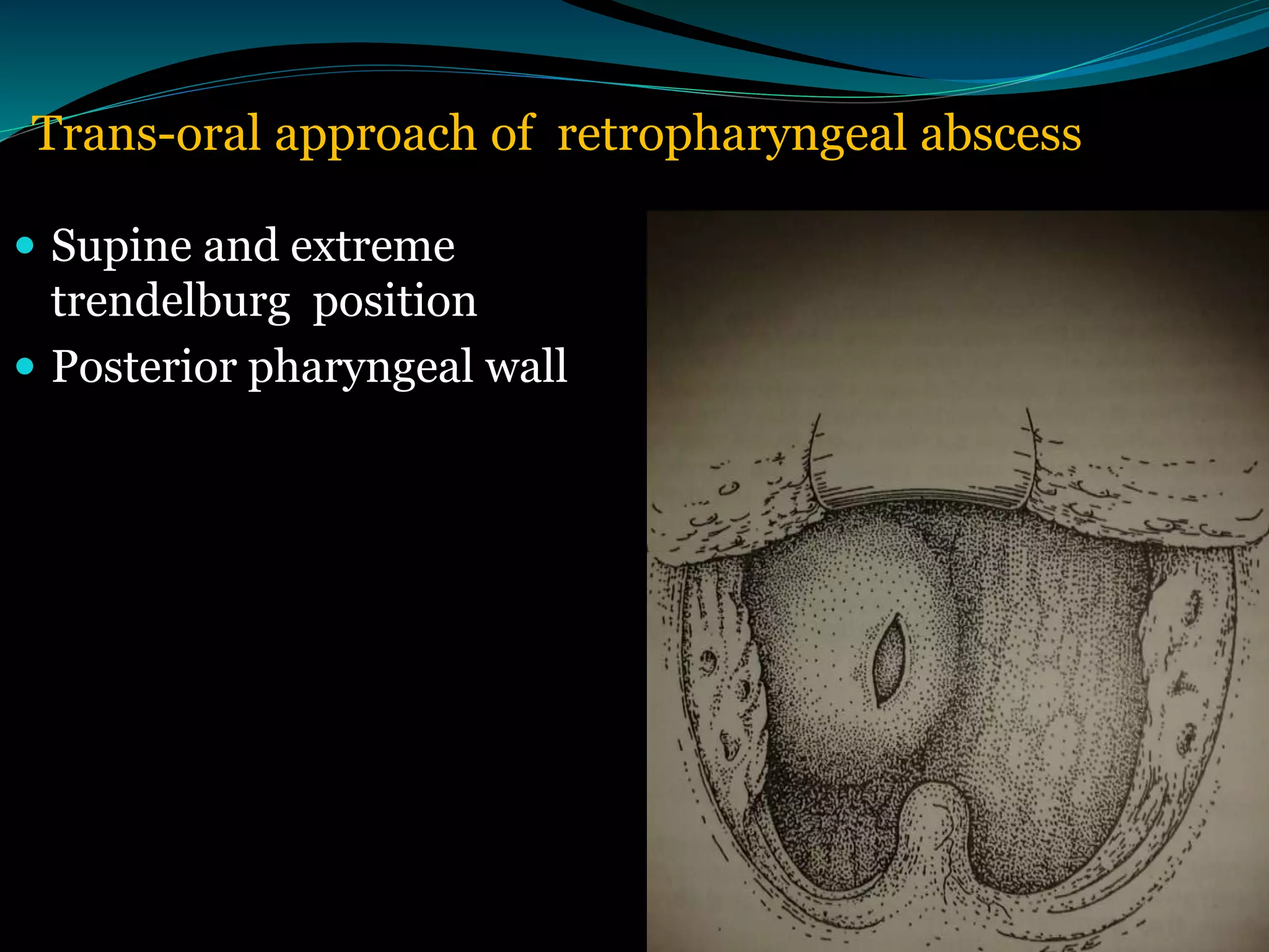 Surgical treatment of paraphyrngeal and retropharyngeal abscesses | PPTX