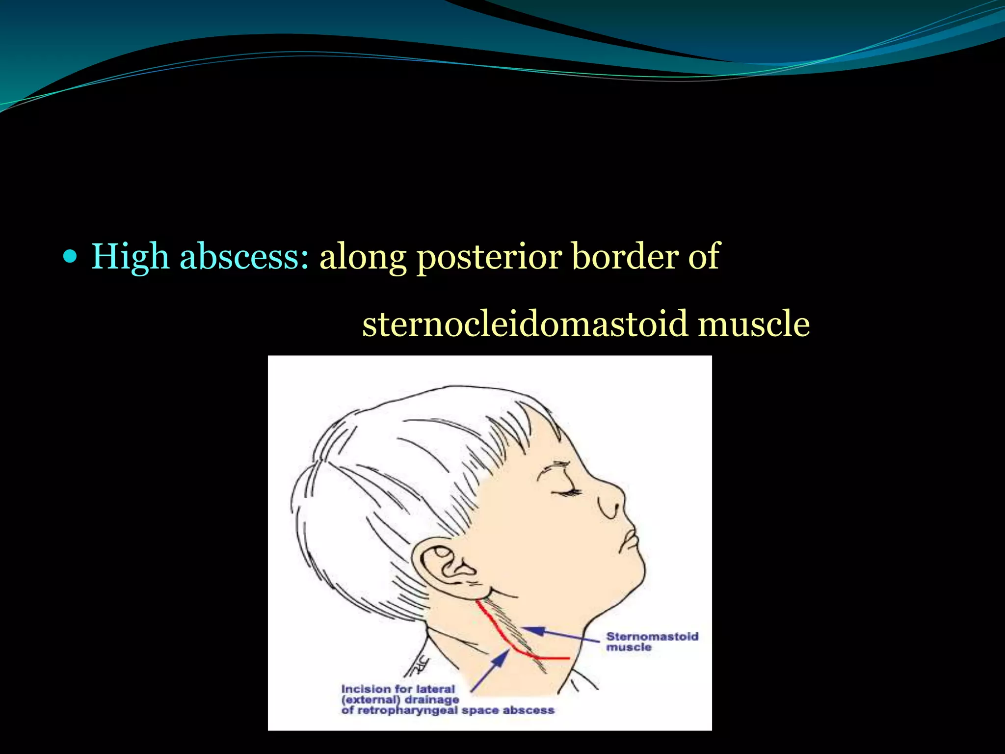 Surgical treatment of paraphyrngeal and retropharyngeal abscesses | PPTX