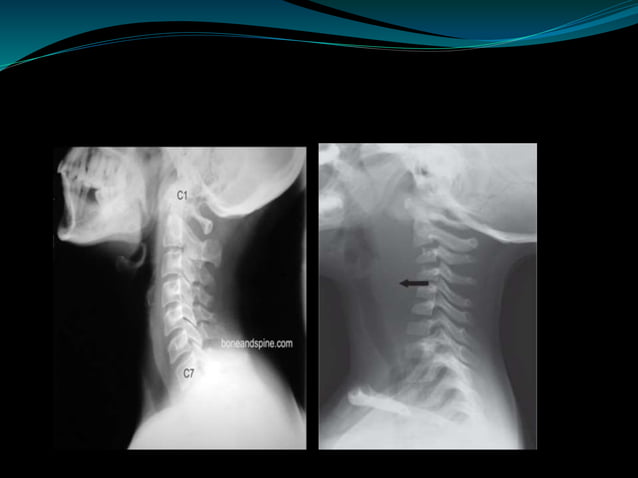 Surgical treatment of paraphyrngeal and retropharyngeal abscesses | PPTX