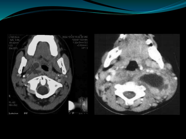 Surgical treatment of paraphyrngeal and retropharyngeal abscesses | PPTX